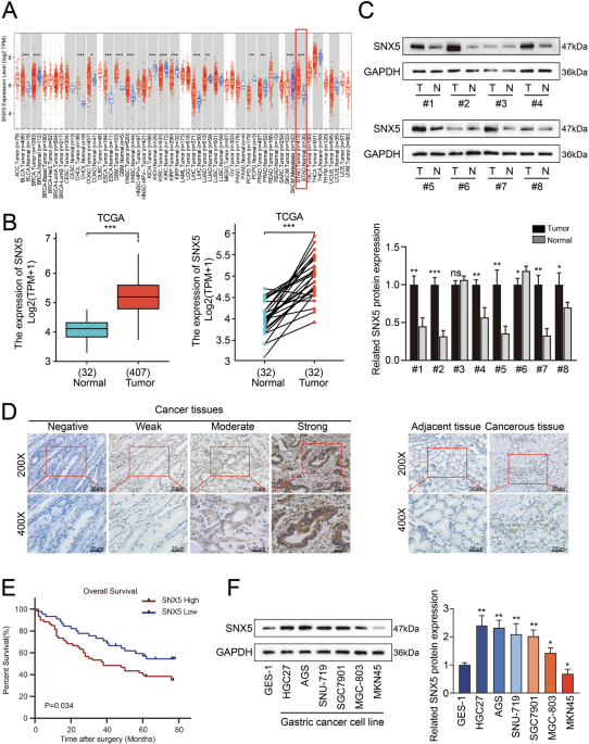 SNX5 facilitates the progression of gastric cancer by increasing the ...
