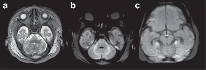 MRI scoring systems for long-term outcome prediction in Neonatal ...