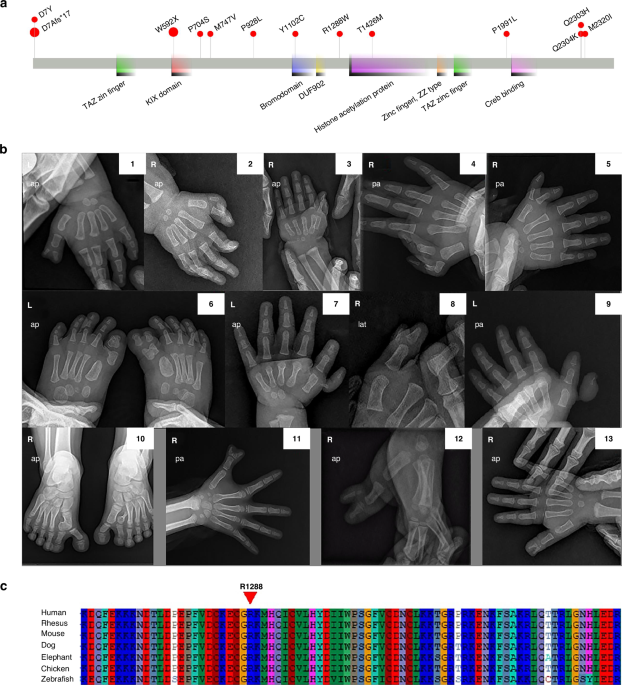 Functional analysis of a novel pathogenic variant in CREBBP associated ...