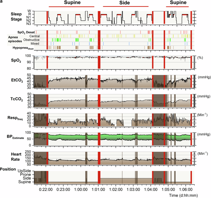 Upper airway obstruction during sleep in infants with laryngomalacia is ...