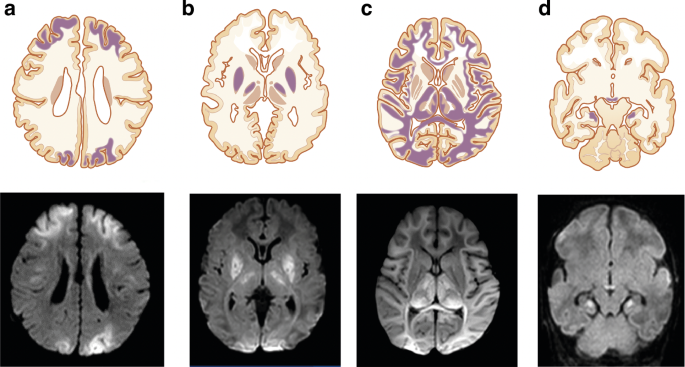 Neonatal encephalopathy and hypoxic-ischemic encephalopathy: the state ...