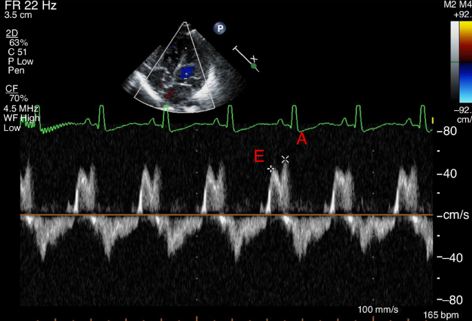 Blood flow assessment in echocardiography of hemodynamically ...
