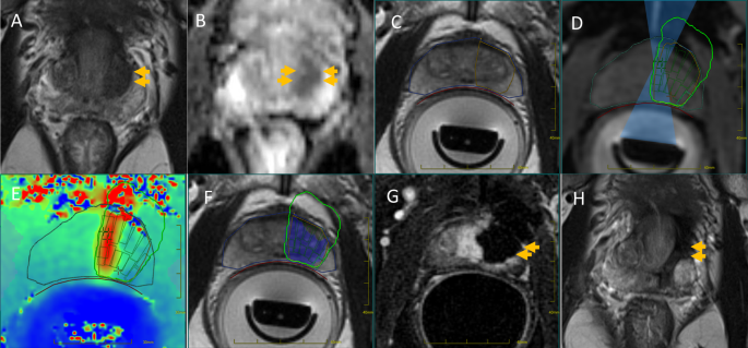 New kids on the block: MRI guided transrectal focused US, TULSA, focal ...