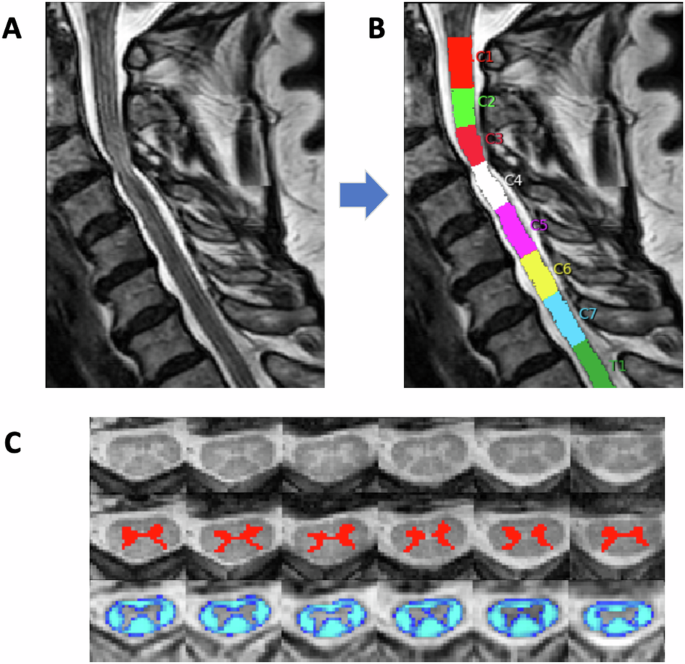 White matter spinal tracts impairment in patients with degenerative cervical myelopathy ...