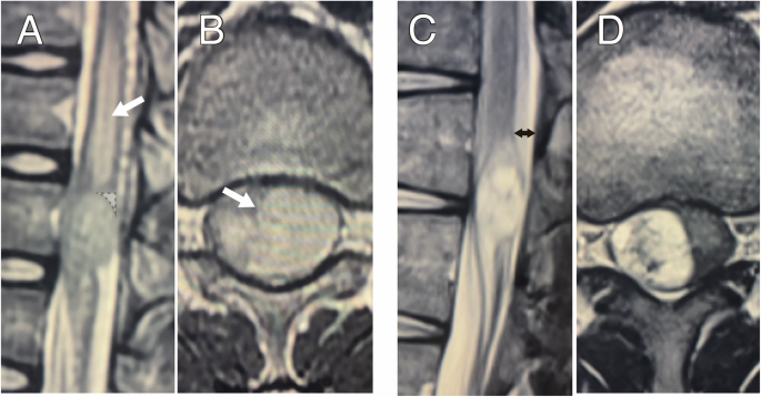 Comparative analysis of MRI features and surgical outcomes between ...