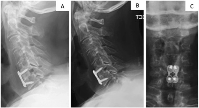 Autonomic dysreflexia caused by cervical stenosis | Spinal Cord Series ...