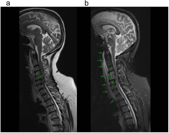 Spinal cord injury as a result of Staphylococcus aureus pyogenic spinal infection complicating ...