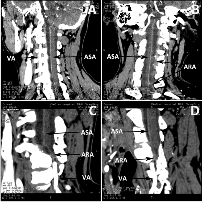 Occlusion of vertebral artery and anterior spinal artery in cervical ...