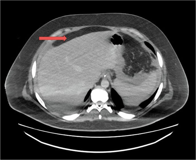 Haemoperitoneum in the setting of therapeutic anticoagulation and ...