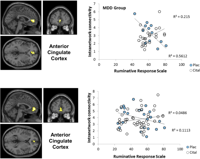 Regional default mode network connectivity in major depressive disorder ...