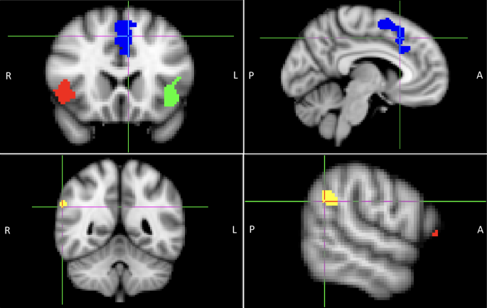 Neural and behavioral markers of inhibitory control predict symptom ...