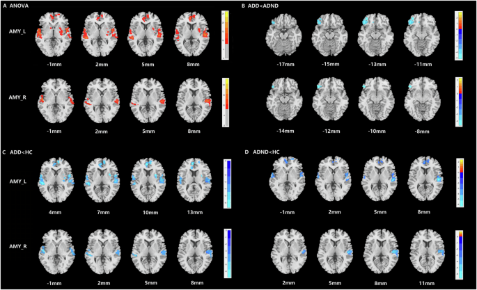The mediating effect of the amygdala-frontal circuit on the association ...