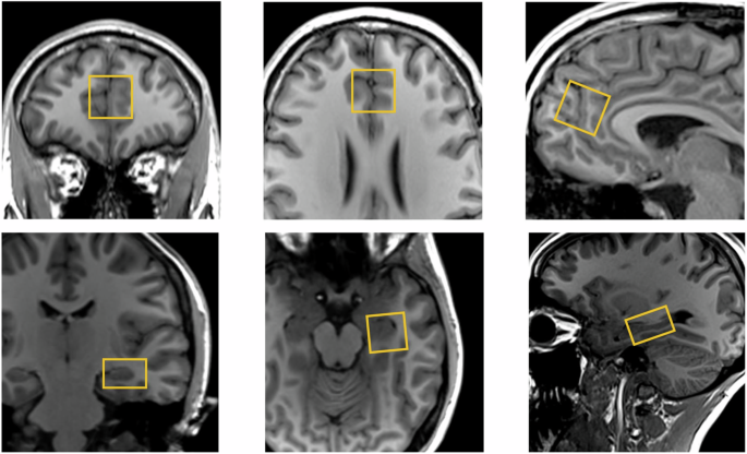 The relationship between cortical synaptic terminal density marker SV2A and glutamate early in ...