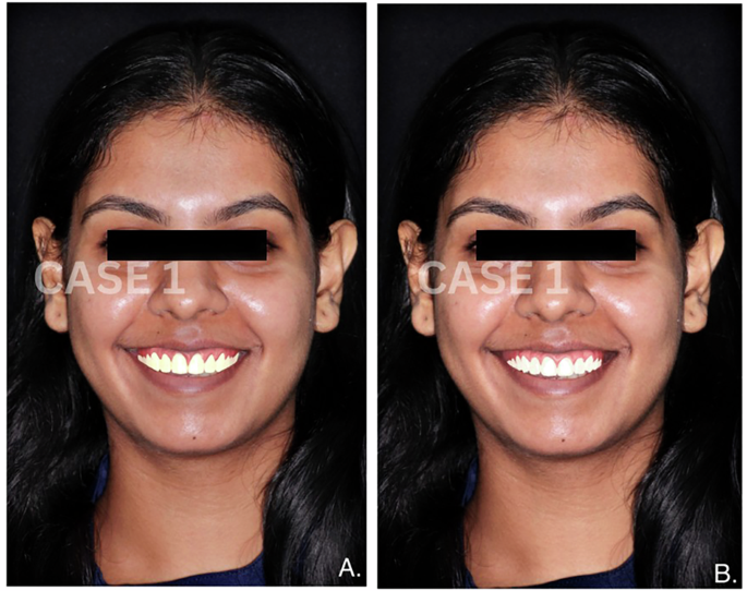 Comparative analysis of facial aesthetics in AI generated versus ...