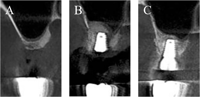 External sinus lift with simultaneous implant placement for severely ...