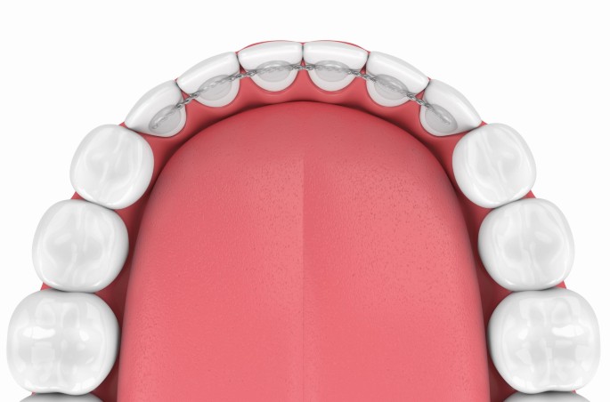 Orthodontics in the city: when to use a laboratory-made bonded retainer ...