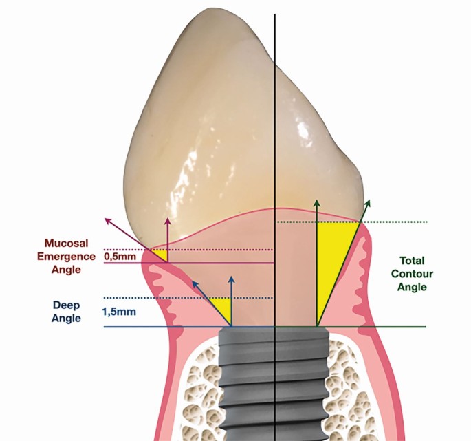 Prosthetic design and choice of components for maintenance of optimal ...