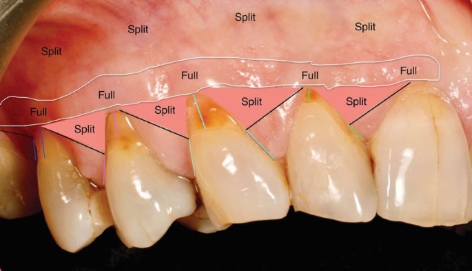 Advanced soft tissue management | British Dental Journal