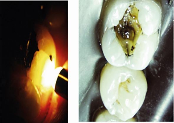 Long-term complications and management of dental trauma in the adult ...