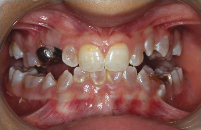 Perceived oral care needs and concerns of individuals with osteogenesis ...
