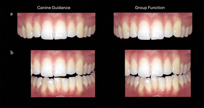 Principles guiding the restoration of the root-filled tooth | British ...