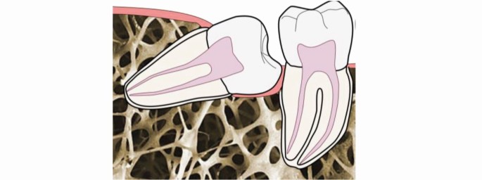 Prevalence of disease associated with horizontal and mesioangular ...