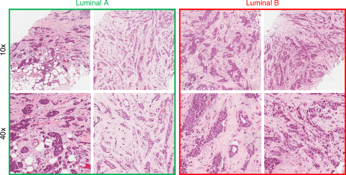Machine learning-based prediction of luminal breast cancer subtypes ...