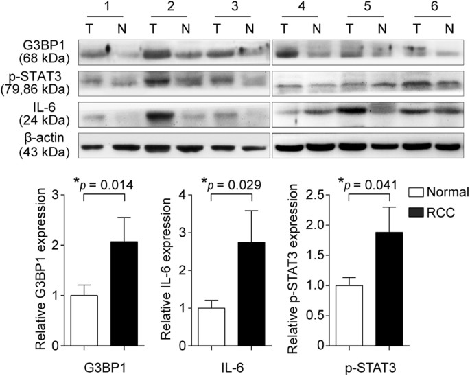 G3BP1 promotes tumor progression and metastasis through IL-6/G3BP1 ...