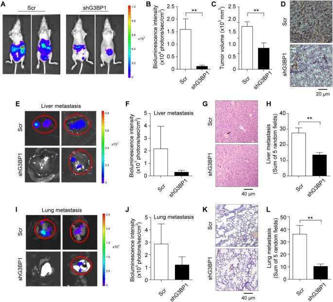 G3BP1 promotes tumor progression and metastasis through IL-6/G3BP1 ...