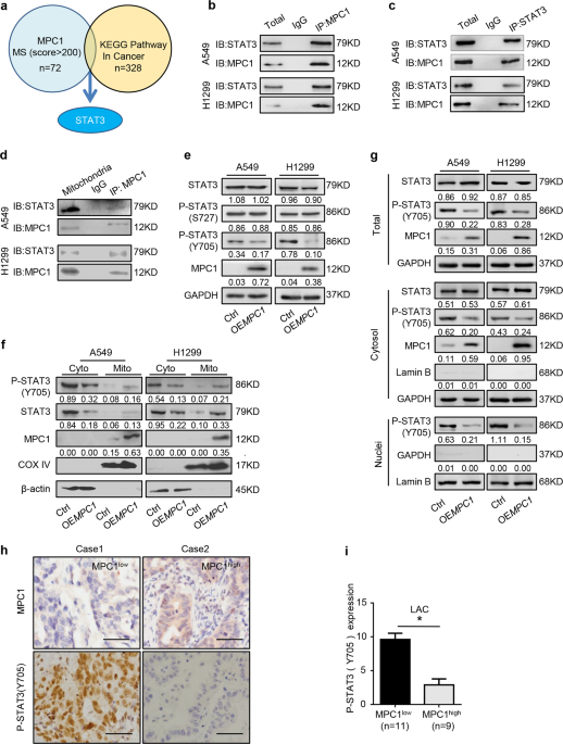 MPC1 deficiency accelerates lung adenocarcinoma progression through the ...