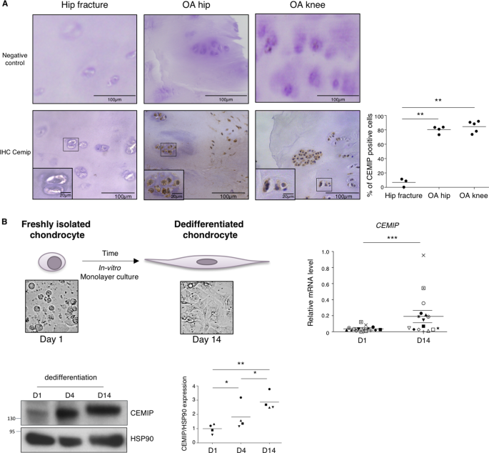 CEMIP (KIAA1199) induces a fibrosis-like process in osteoarthritic ...