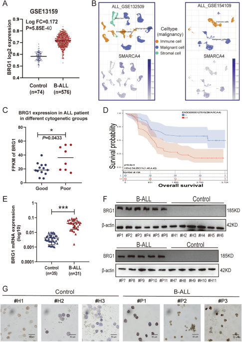 BRG1 promotes progression of B-cell acute lymphoblastic leukemia by ...
