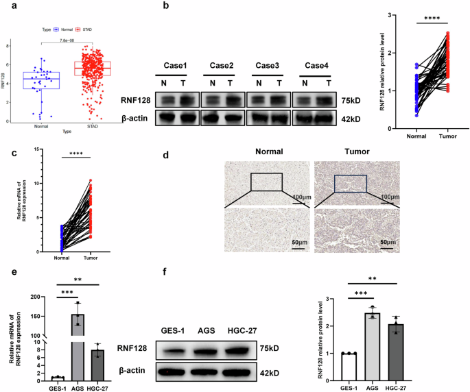 RNF128 promotes gastric cancer progression by inhibiting autophagy ...