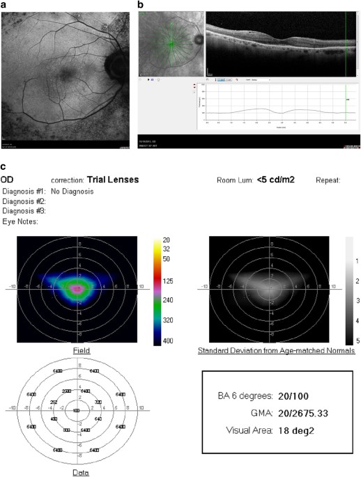 Improved retinal and visual function following panmacular subthreshold ...