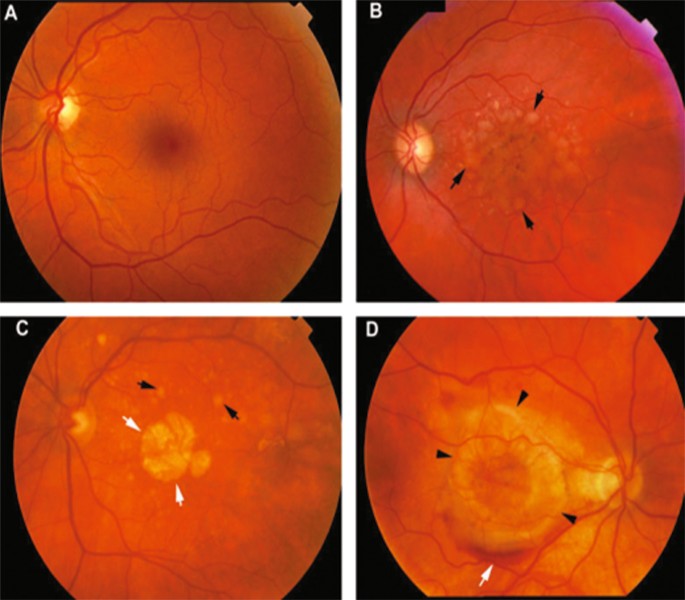 What do we know about the macular pigment in AMD: the past, the present ...