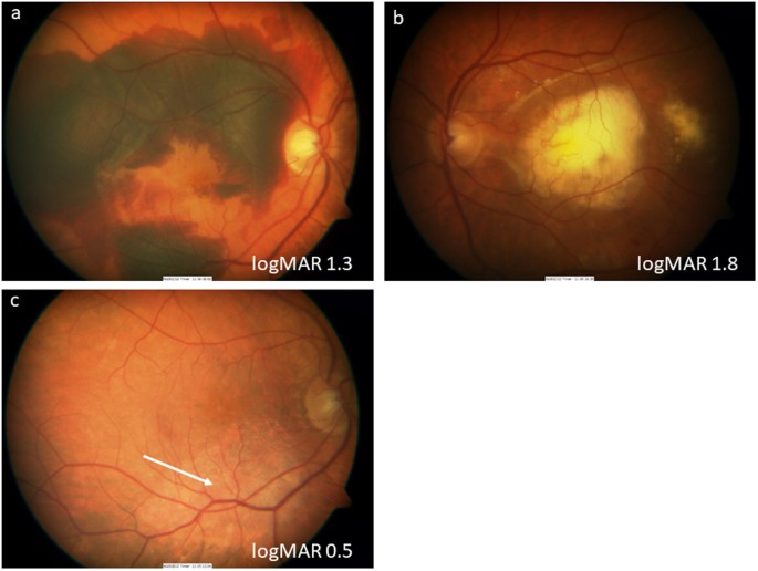Cellular regeneration strategies for macular degeneration: past ...
