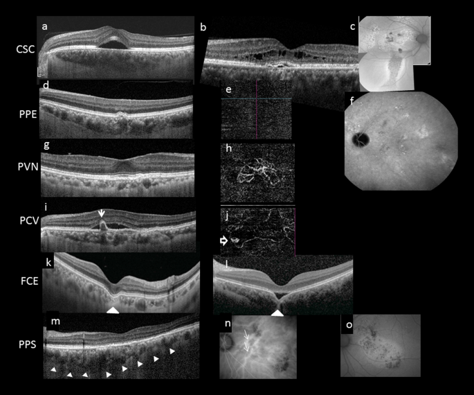 Pachychoroid disease | Eye