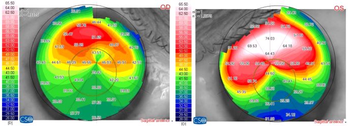 Corneal topography image of bilateral superior pellucid marginal ...