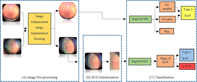 Automated detection of type 1 ROP, type 2 ROP and A-ROP based on deep learning | Eye