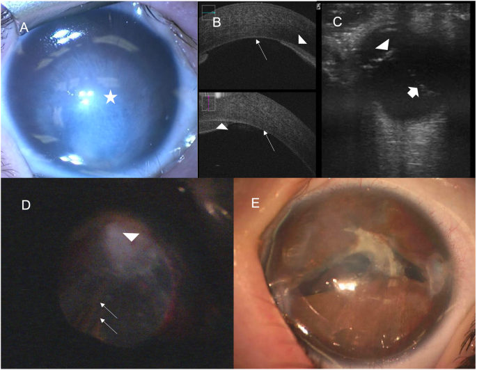Persistent foetal vasculature masquerading as Peters anomaly | Eye