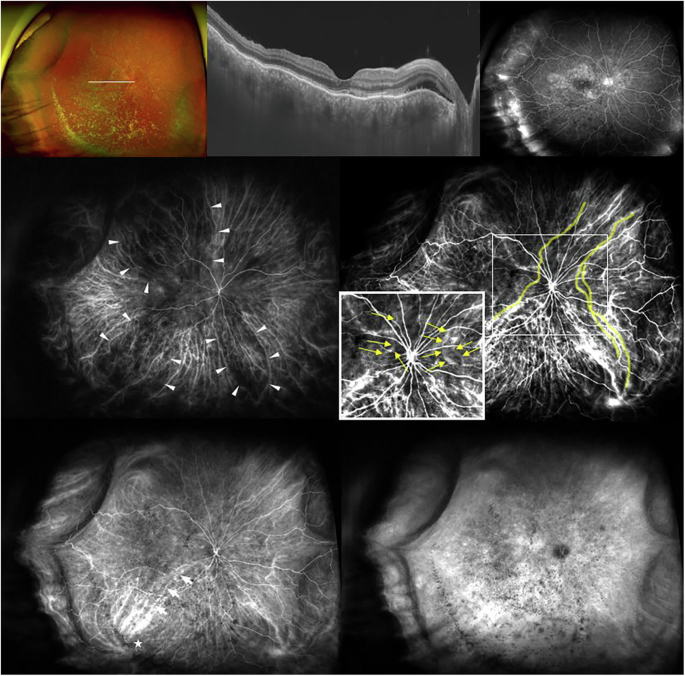 Choroidal venous overload in Vogt‒Koyanagi‒Harada disease | Eye