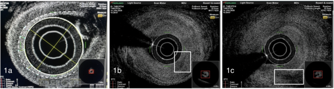 Optical frequency domain imaging (OFDI) represents a novel technique ...