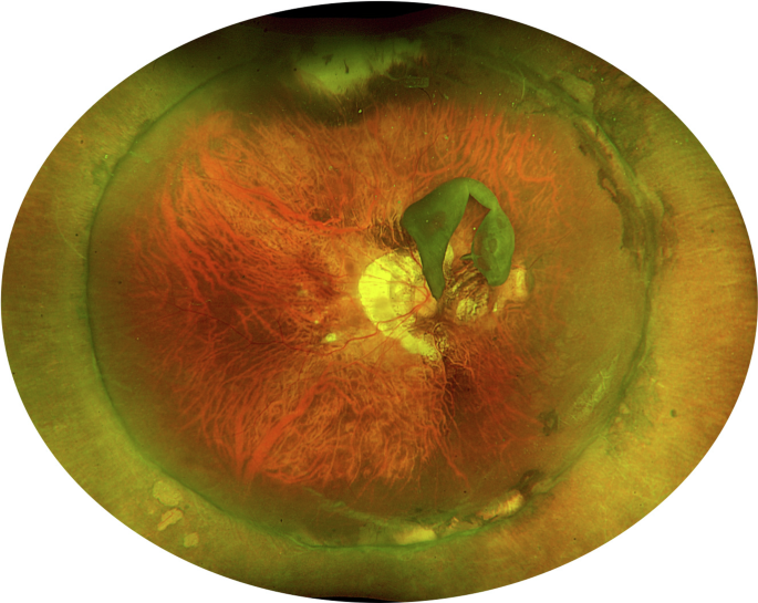 Deceptive vision: when posterior vitreous detachment mimics retinal ...