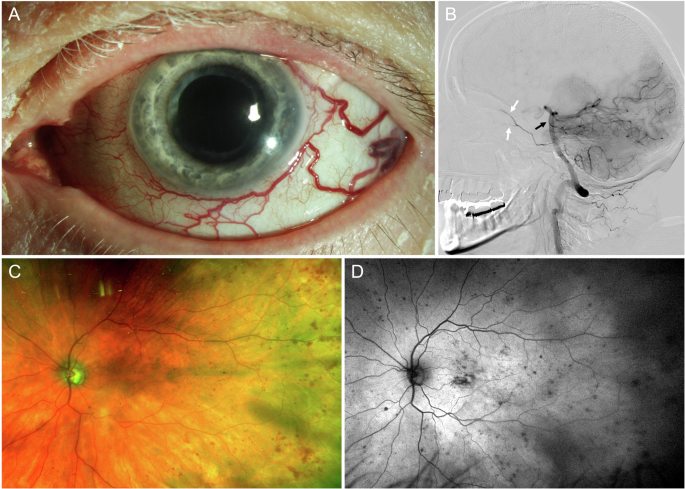 Orbital venous congestion due to intracranial arteriovenous fistula | Eye
