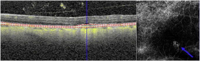 Optical coherence tomography angiography in neovascular age-related ...