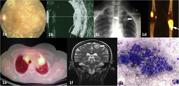Choroidal metastases with exudative retinal detachment as the initial ...