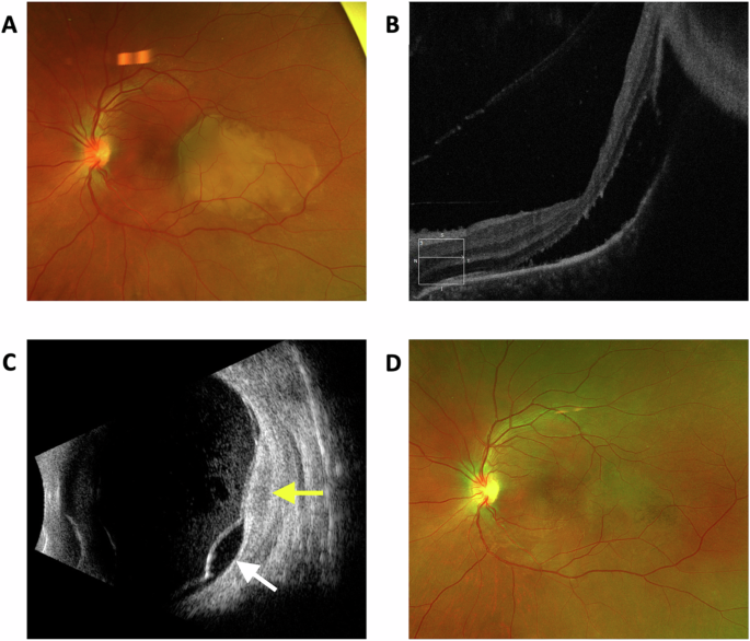 Tuberculous choroidal granuloma | Eye