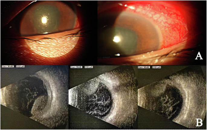 The diagnosis and treatment progress of infectious endophthalmitis | Eye