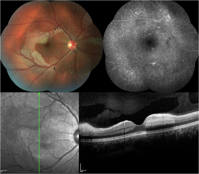 Gass plaques in Susac syndrome | Eye