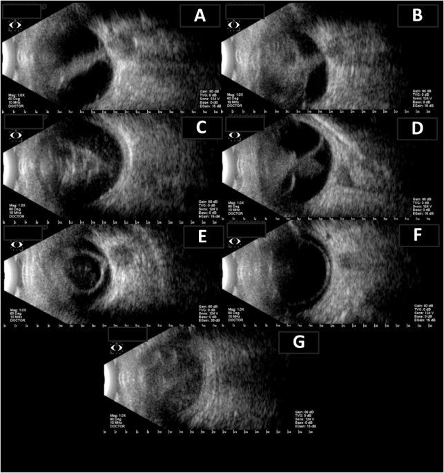 Novel ultrasound-based classification of retinal funnel patterns in ...